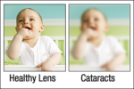 Cataracts Long Island | Understanding Cataracts Garden City | Stahl Eye